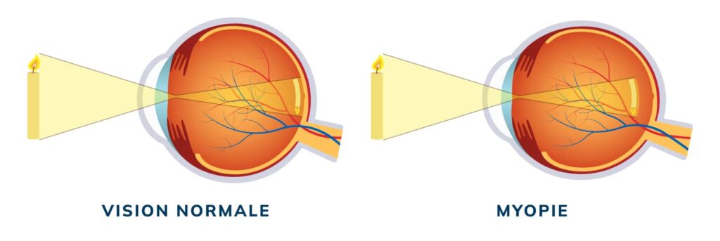 Myopie : traitements à Strasbourg | Trouble de la vue et maladie de l ...